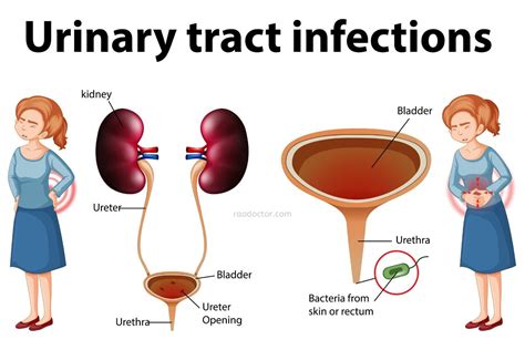 Urinary Tract Infections How To Diagnose And Treat Them