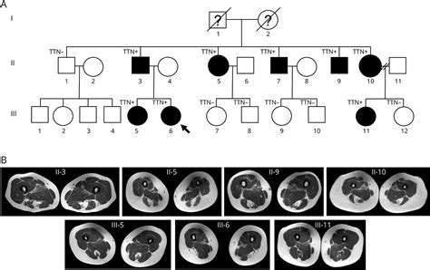 A Titin Truncating Variant Causing A Dominant Myopathy With Cardiac