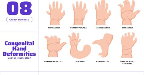 Congenital Hand Deformity Constriction Type Objects Ft Congenital