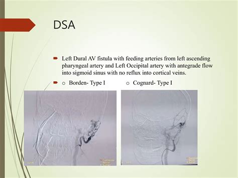 Sigmoid Sinus Dural Arterio Venous Fistula A Case Presentation Pptx
