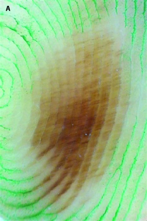 Regular Fibrillar Pattern Of Acral Nevus Dermoscopy With The Furrow Download Scientific