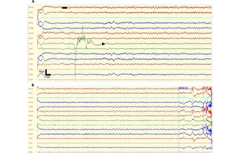 Electroencephalogram Findings A Electroencephalogram Of The Patient Download Scientific