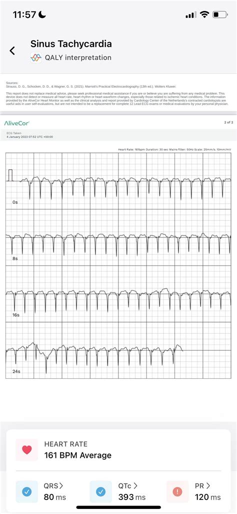 SVT Or Sinus Tachy Lead Ecg Placed On The Chest R Medical