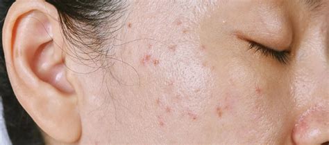 Whiteheads Acne Treatment Nyc Mount Sinai New York