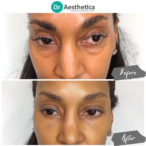 Dark Under Eyes How To Treat Under Eye Bags And Dark Circles Short