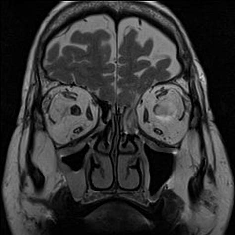 Frontoethmoidal Encephalocoele Pacs