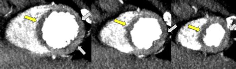 A Low Dose Comprehensive Cardiac Ct Protocol Assessing Anatomy Function Perfusion And