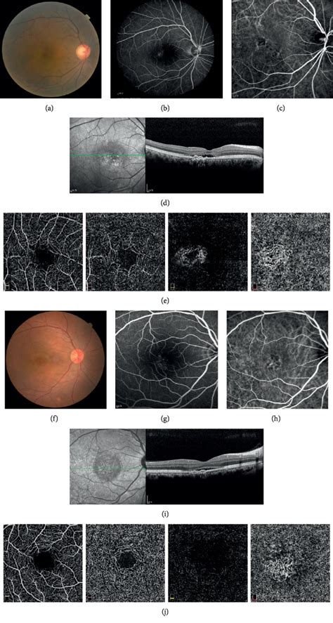 Choroidal Neovascularization Secondary To Central Serous Chorioretinopathy Oct Angiography