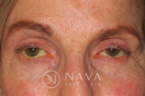 Mohs Reconstruction Before And After Photos Nava Face And Eye