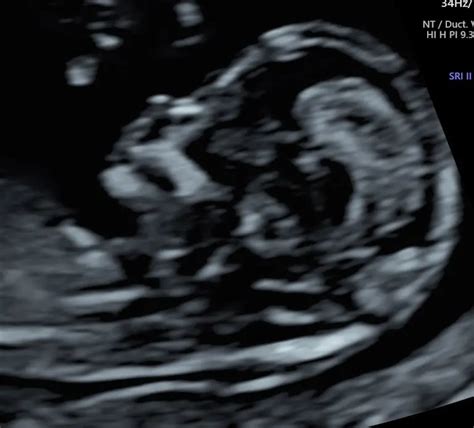 Nuchal Translucency Scan Sydney 12 14 Weeks Cfwu