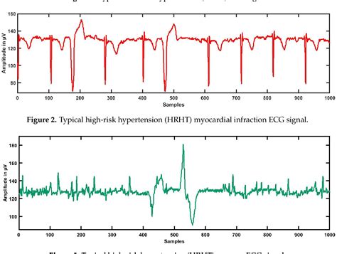 Table 1 From Hypertension Diagnosis Index For Discrimination Of High Risk Hypertension Ecg