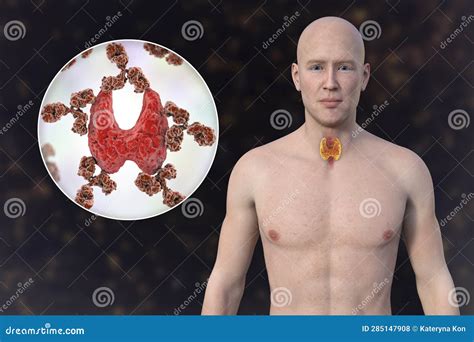 Autoimmune Thyroiditis Conceptual Illustration Stock Illustration Illustration Of Hashimoto