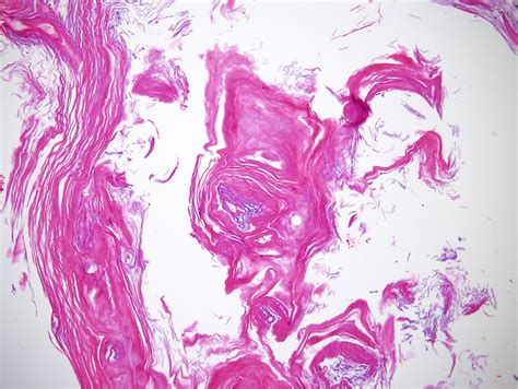Obstruction Of The External Auditory Canal By A Keratin Cast Keratosis