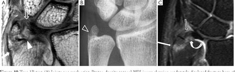 Figure 1 From Mr Imaging Of The Traumatic Triangular Fibrocartilaginous Complex Tear Semantic