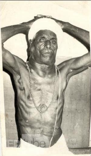 Malignant Lymphadenopathy • Image •