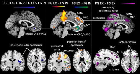 significant clusters for the conjunction left part of performance