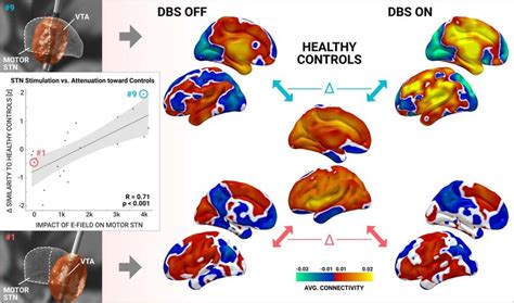 The Shift Of Whole Brain Average Connectivity Profiles Toward That Of