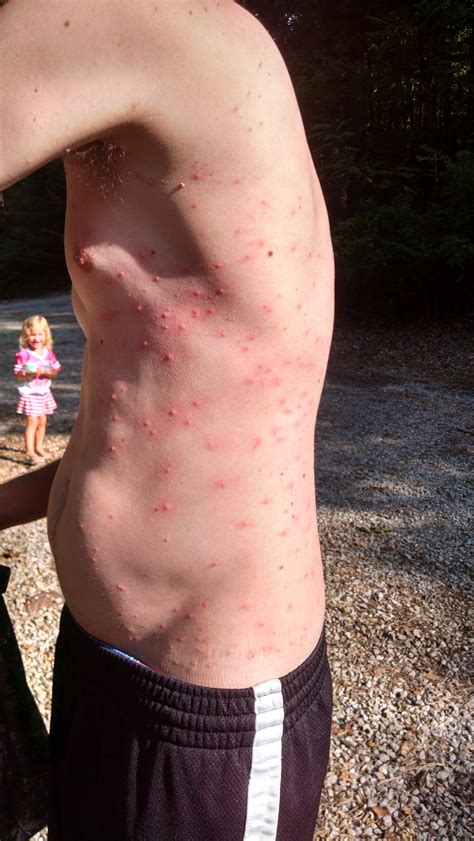 Chiggers Chigger Bites And How To Get Rid Of Chiggers Deer Hunter Tips