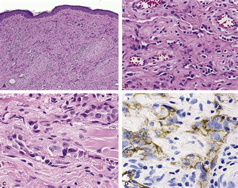 Angiosarcoma Ento Key