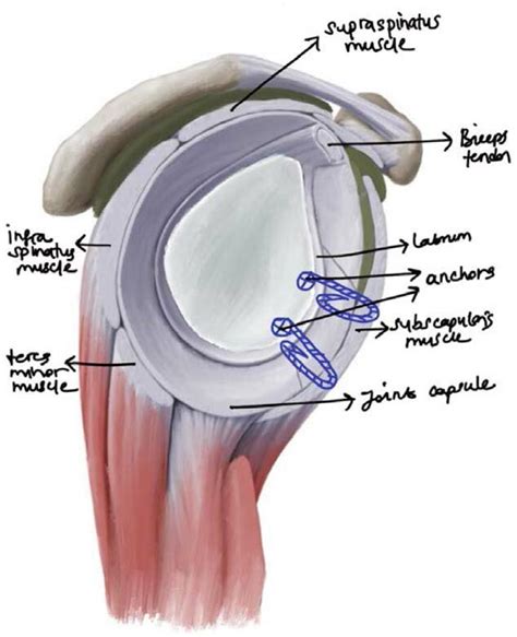 Illustration Of The Surgical Technique The Subscapularis Tendon And Download Scientific