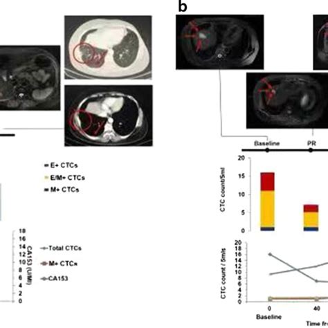 Comparison Of Total Ctc Count Ctc Phenotype Serum Tumor Markers And