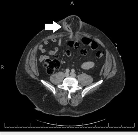 Axial Ct Showing Umbilical Hernia Containing The Appendix Download