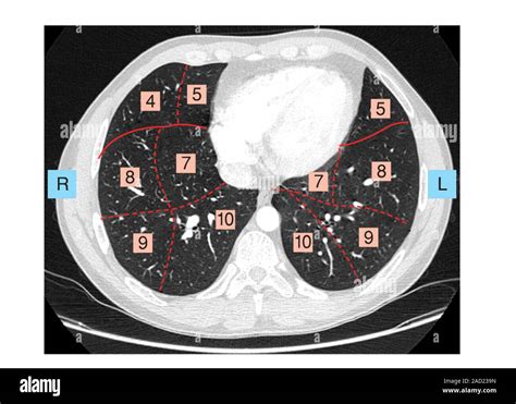 Illustration Of The Lungs Pulmonary Segmentation In Thoracic Ct This