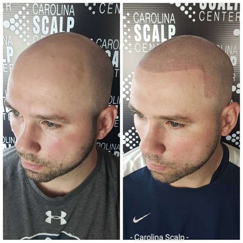 Scalp Micropigmentation Aftercare Carolina Scalp Center Carolina