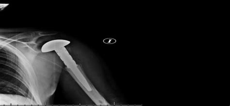 Marginal Tumor Resection With Partial Tumor Prosthesis Reconstruction Download Scientific Diagram