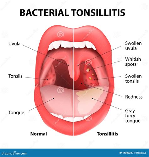 Tonsillitis Bacterial Stock Vector Illustration Of Barr 44085227