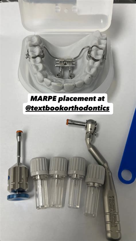 Marpe Palatal Expander For Adults — Los Angeles Ca