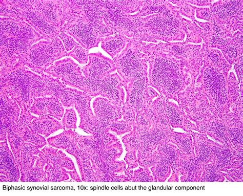 Pathology Outlines Synovial Sarcoma