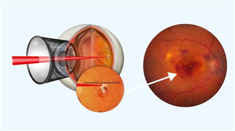 Preventing Neovascularization From Contact Lenses Essential Tips Eyecandys®