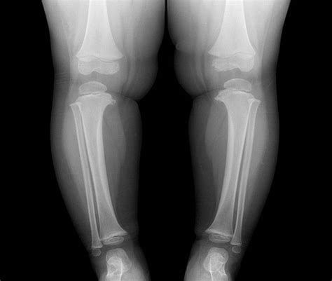 Tibial Varum Kevinroot Medical Tibial Varum Kevinroot Medical