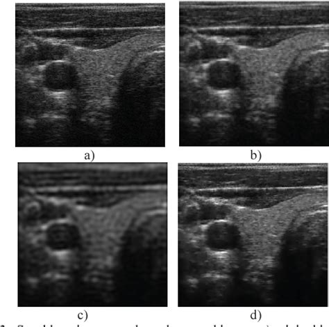 Figure 3 From Speckle Noise Removal In Ultrasound Images Using Sparse