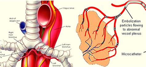 How Does The Procedure Work