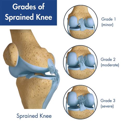 Sprained Knee Treatment Madison Wi Knee Sprain Specialist In Wi
