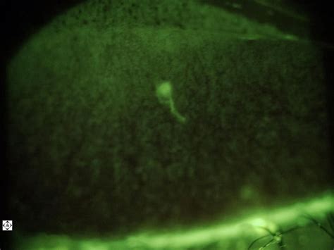 Sonoran Desert Eye Center Palpebral Conjunctiva Foreign Body