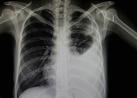 From Decades To Days 3d Modelling Tuberculosis Pursuit By The University Of Melbourne