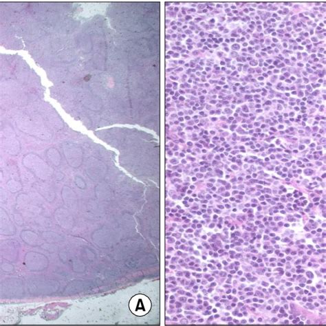 Pathologic Findings Of Peripancreatic Lymph Nodes A It Showed