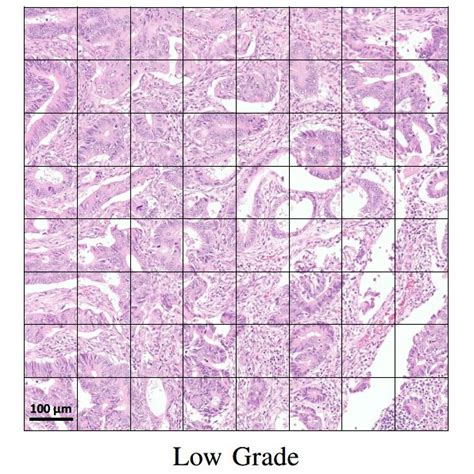 Pdf Context Aware Convolutional Neural Network For Grading Of Colorectal Cancer Histology Images