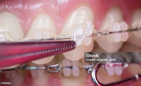 치과 세라믹 브라켓 이빨 치료 치과 사무실에서 모기를 사용 하 여 중괄호와 치아의 매크로 샷입니다 교정 치료입니다 치과 개념에 대한 스톡 사진 및 기타 이미지 Istock