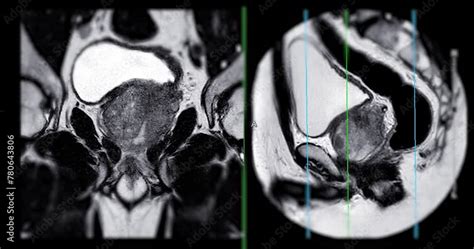 Mri Of The Prostate Gland Reveals A Focal Abnormal Signal Intensity Si