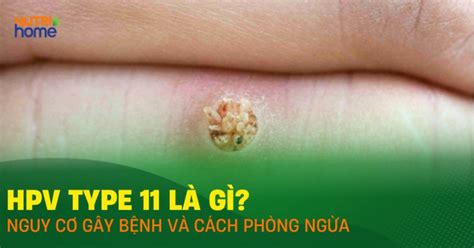 Hpv Type 11 Là Gì Nguy Cơ Gây Bệnh Và Cách Phòng Ngừa
