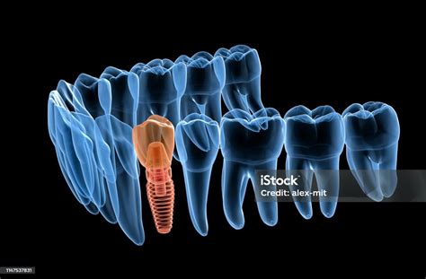 임 플 란 트 엑스레이 보기를 가진 사전 몰 이빨 회복 인간의 치아와 의치 개념의 의학적으로 정확한 3d 그림 치아 임플란트에 대한 스톡 사진 및 기타 이미지 Istock