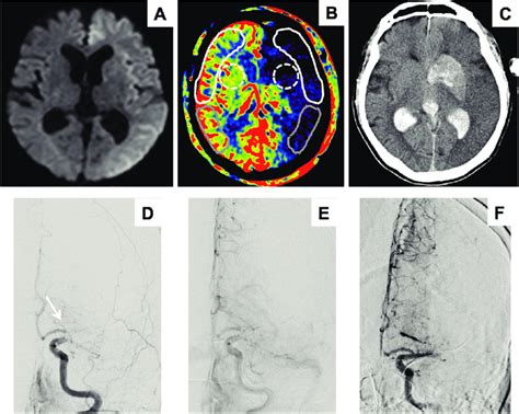 A Mr Diffusion Weighted Imaging On Admission Showing An Acute