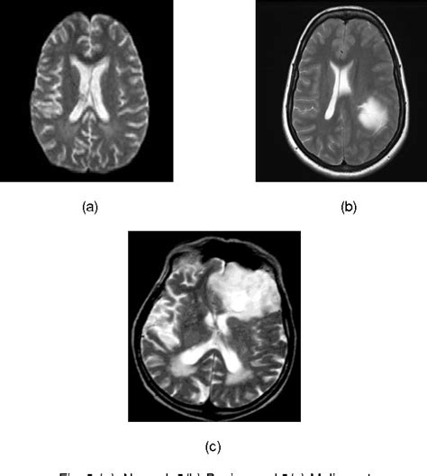 Figure 2 From Brain Tumor Classification Using Wavelet And Texture Based Neural Network