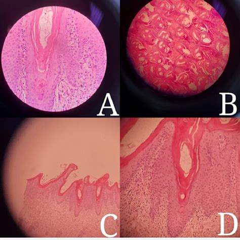 A Epidermal Hyperplasia B Severe Hyperkeratosis C Thick Stratum Download Scientific