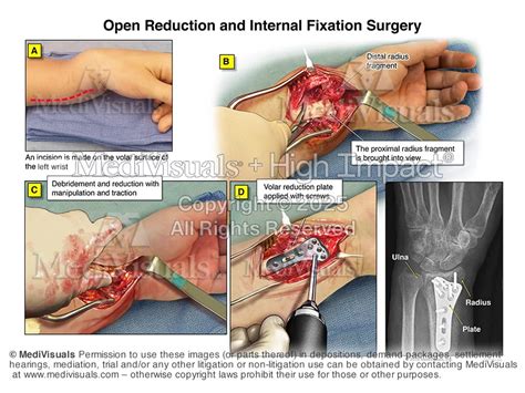 Open Reduction And Internal Fixation Surgery Medivisuals High Impact