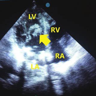 Postoperative First Month Transthoracicechocardiography Apical Four Download Scientific Diagram